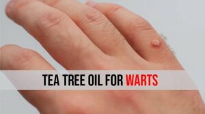 Tea Tree Oil for Warts: Benefits, How to Use, and Remedies | HealthtoStyle